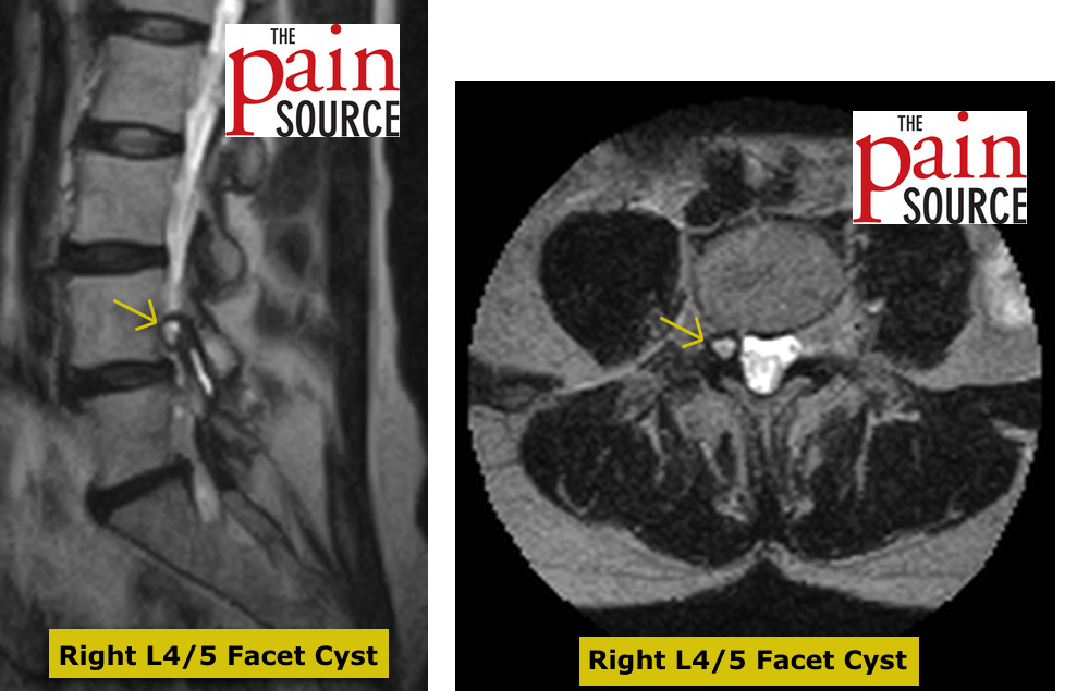 Lumbar Facet Joint Synovial Cyst The Pain Source Lumbar Facet Joint Synovial Cyst The Pain Source